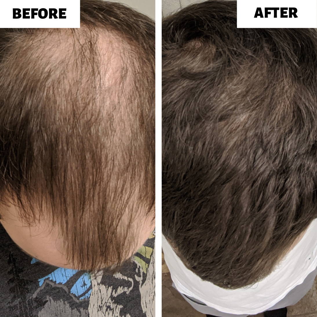 Scalphero™ Shampoo Brush Bundle Scalp Hero